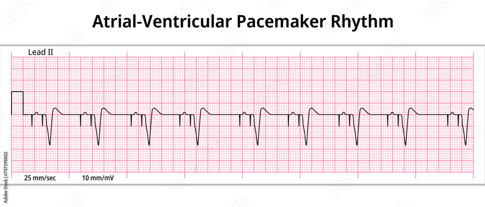 ECG Atrial Ventricular Pacemaker Rhythm - Dual Chamber - 8 Second ECG Paper ...