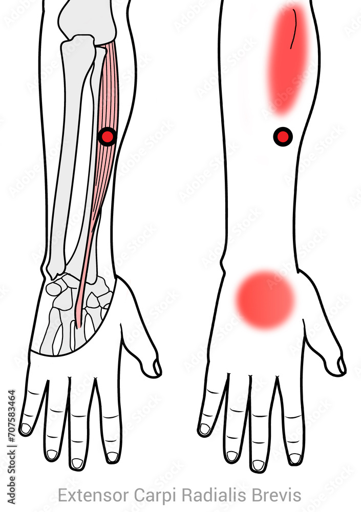 Extensor Carpi Radialis Brevis: Myofascial trigger points and associated pain locations Stock ...