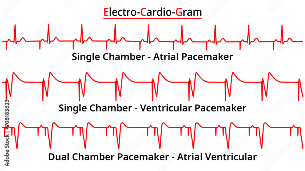 Set of ECG Common Abnormalities - Single vs Dual Chamber Pacemaker ...