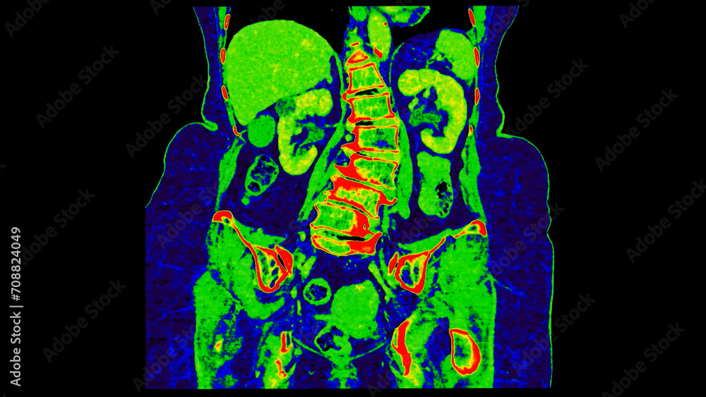 CT scan of Abdomen coronal view with injection contrast media with ...