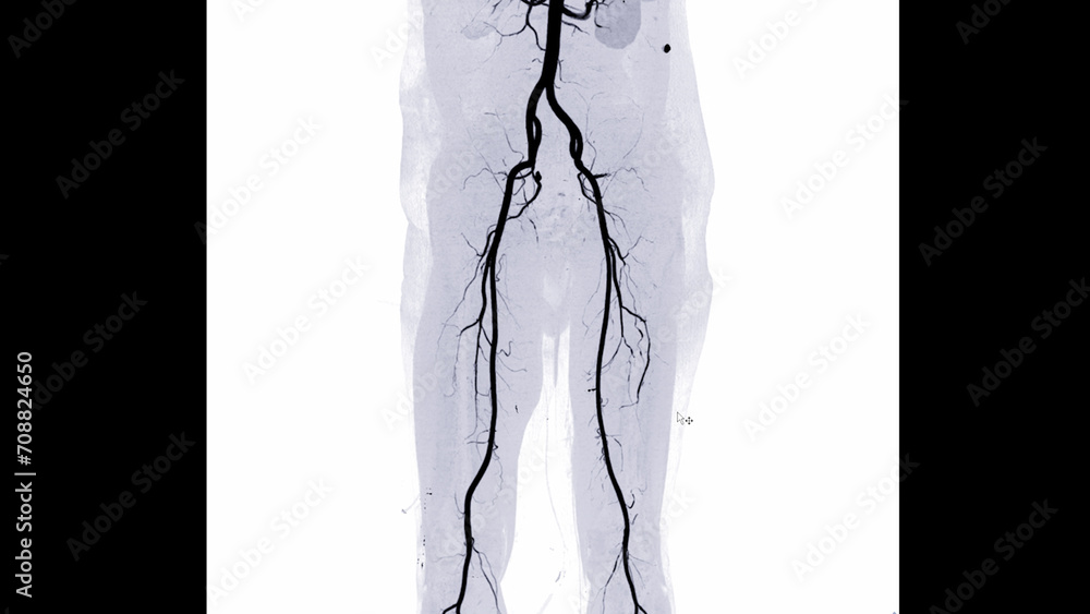 CTA femoral artery run off image of femoral artery for diagnostic Acute ...