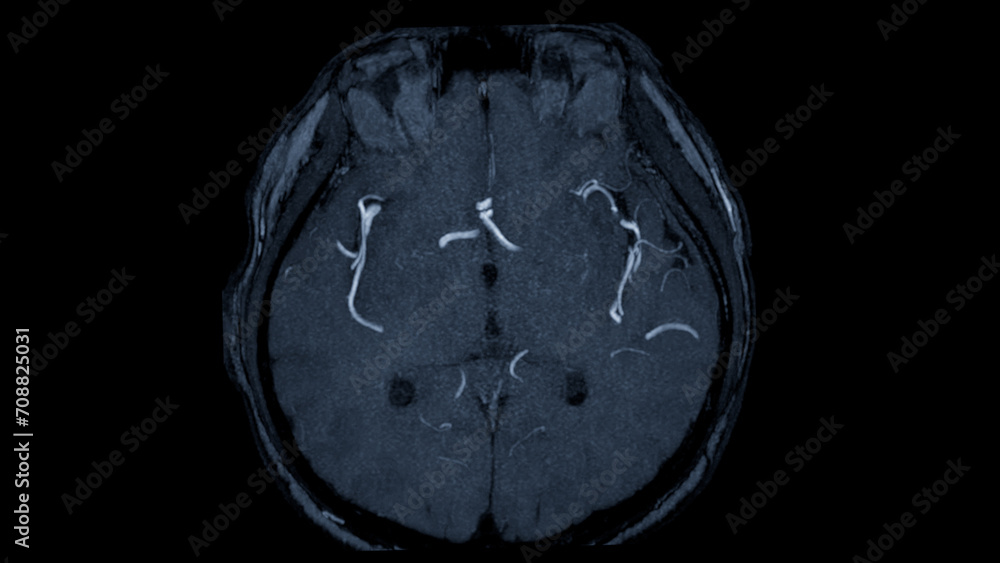 MRA Brain axial view , This imaging technique provides clear visuals of ...