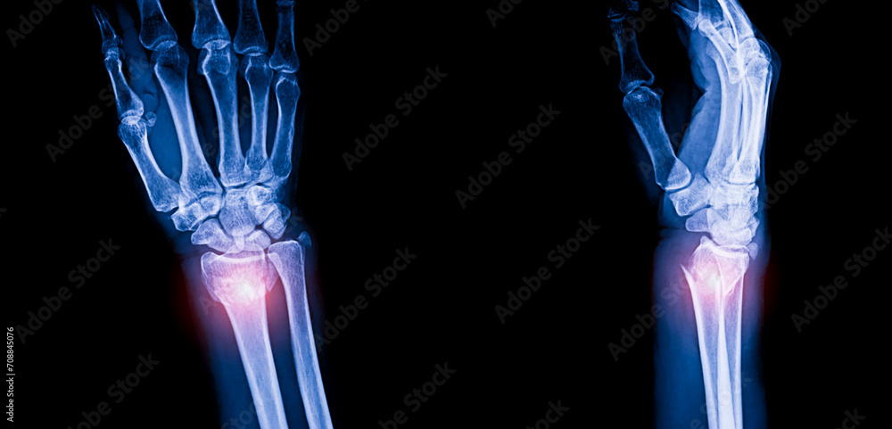X ray image of distal radius fracture colles fracture. Blue tone ...