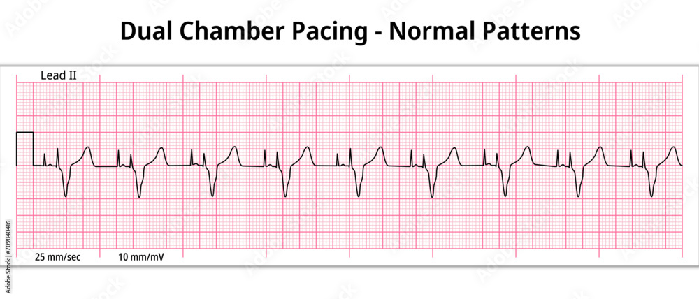 ECG Dual Chamber Pacemaker Rhythm - Normal Pattern - 8 Second ECG Paper ...