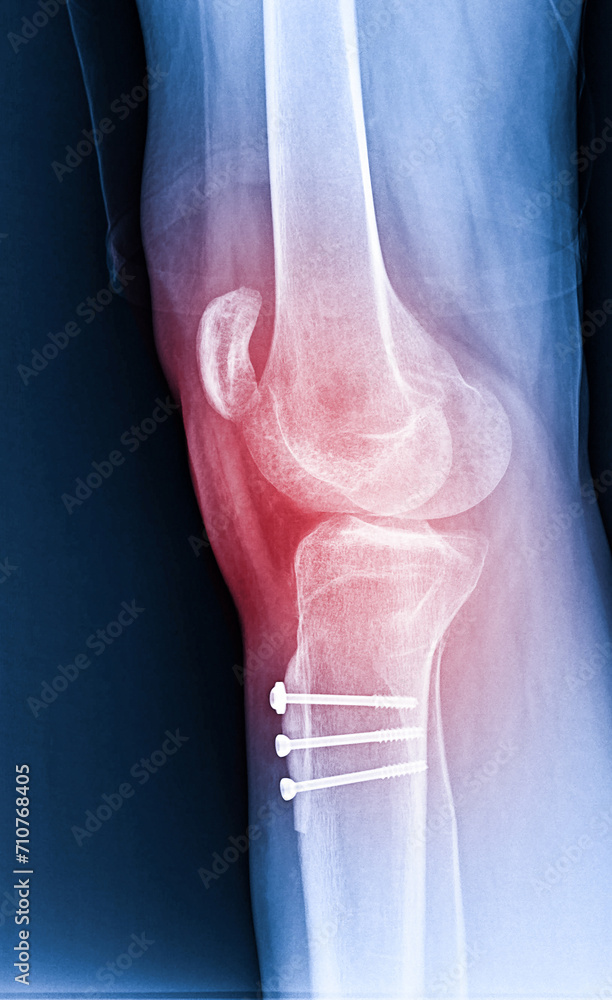 X-ray Knee Joint Fracture proximal tibia and Post fix fracture proximal ...