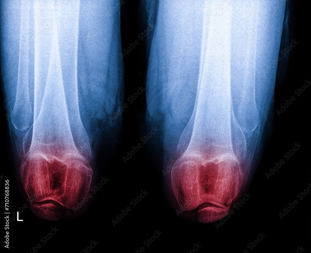 Knee joint x-ray (AP and LATERAL) view fracture and displacement of the ...