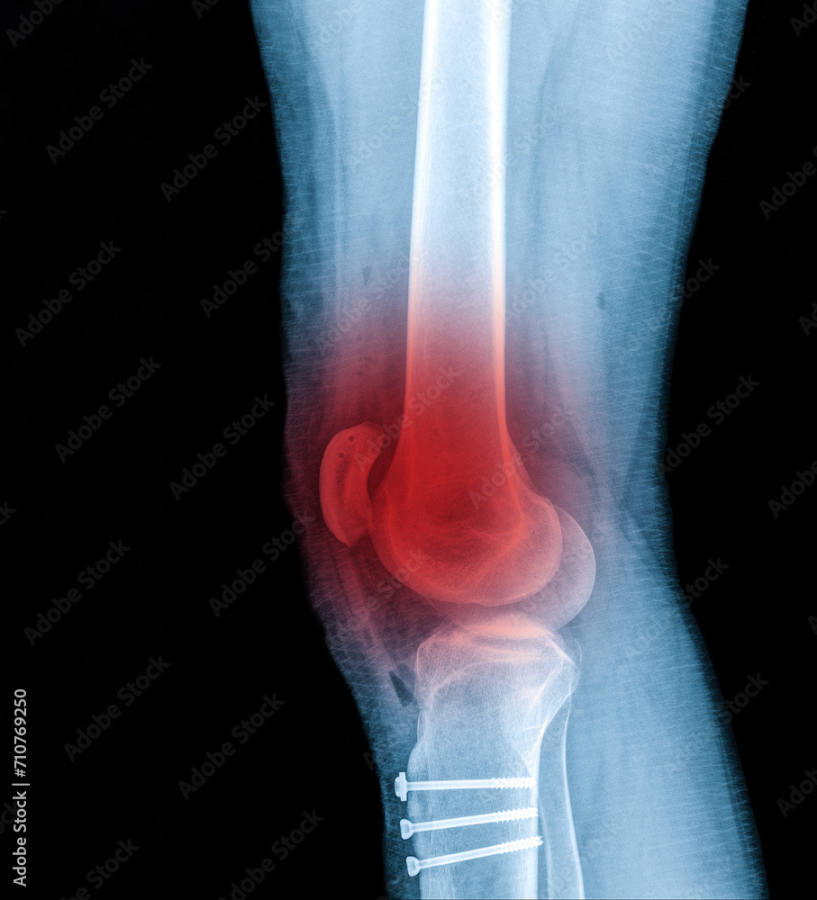 Stock-Foto „X-ray Knee Joint Fracture proximal tibia and Post fix ...