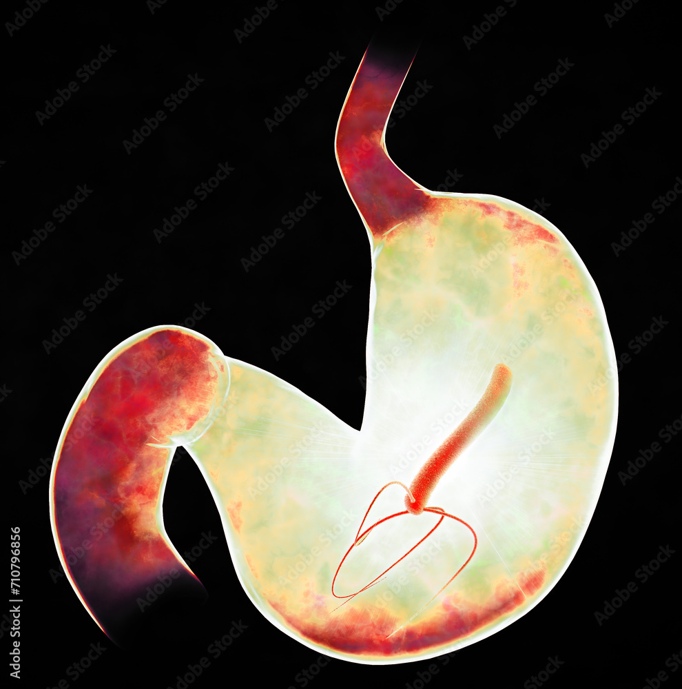 Ilustração Helicobacter pylori is a gram-negative, flagellated, helical ...