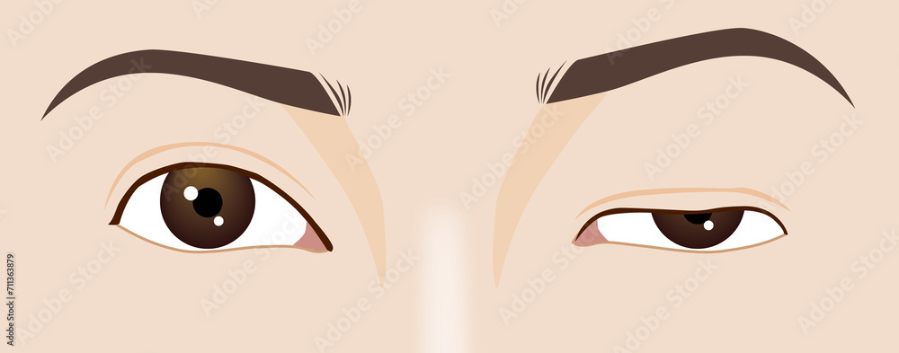 Droopy eyelid ptosis, blepharoplasty symptom, myasthenia gravis ...