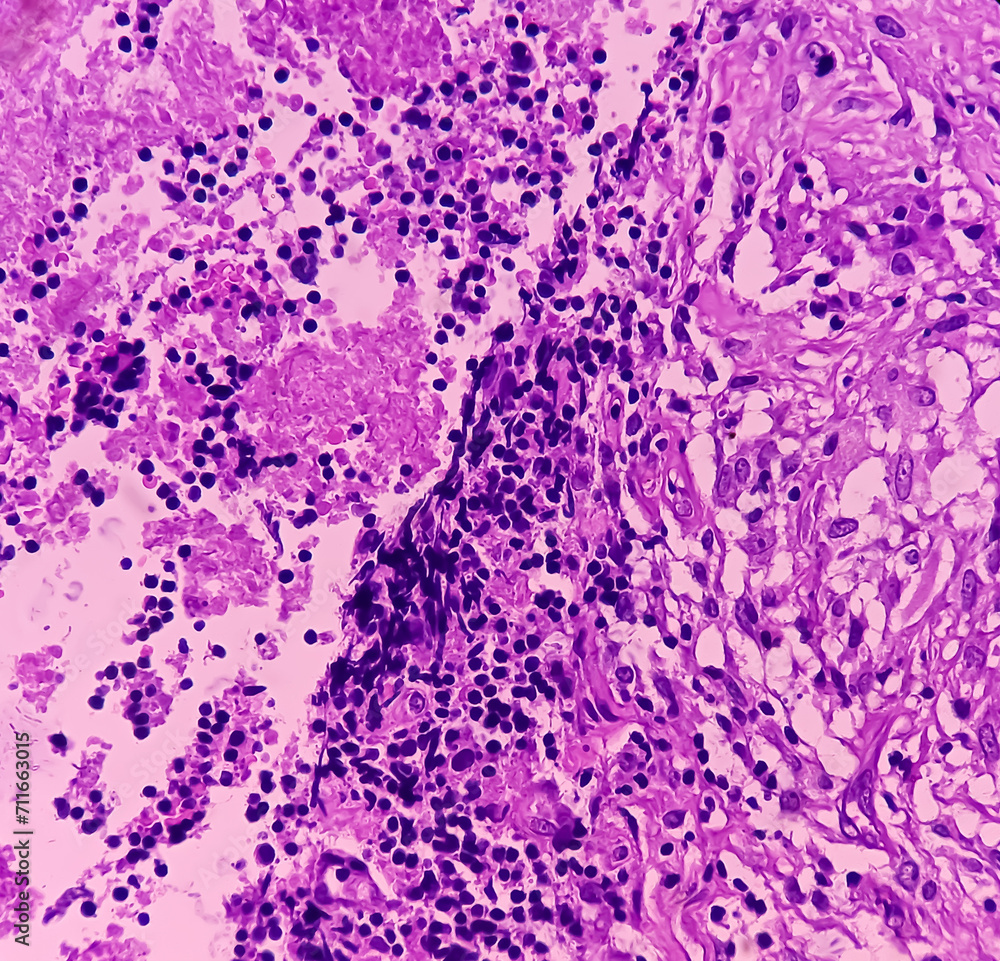 Photo Stock Thyroid cancer: Microscopic image of Follicular neoplasm ...