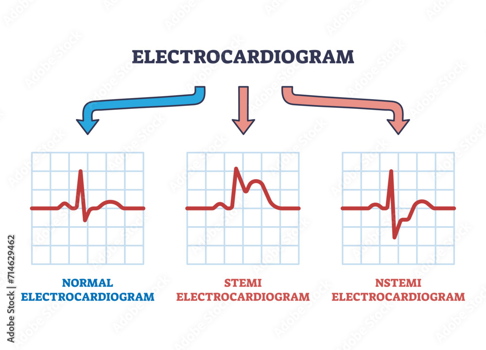 Electrocardiogram STEMI and NSTEMI abnormal heart rate outline diagram ...