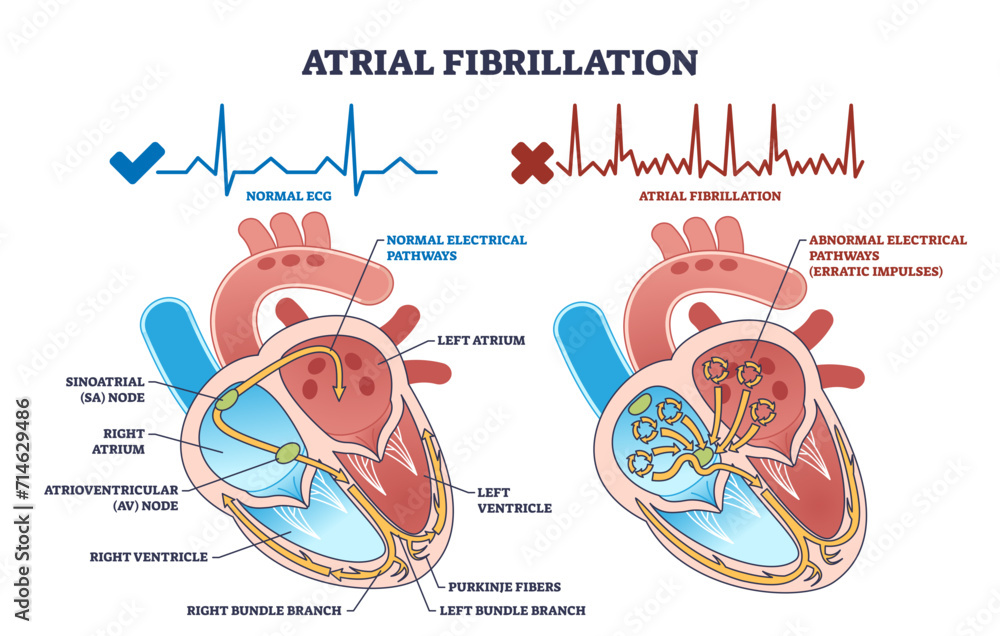 Atrial fibrillation as abnormal heart beat frequency disease outline ...