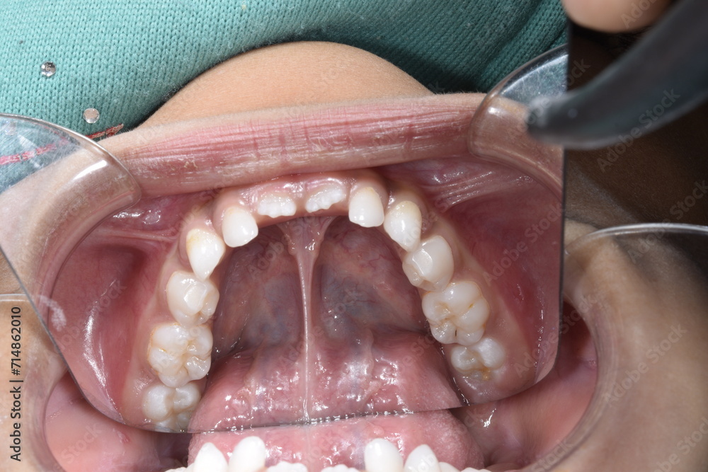 Fotografie Lower mandibular arch occlusal indirect mirror view of a ...