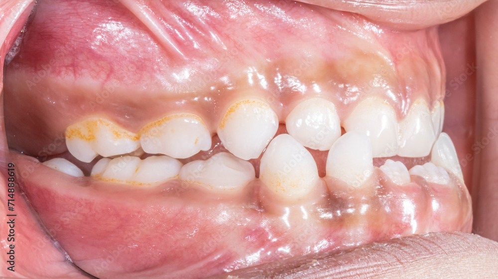 Photo Stock Dentistry clinical case of a young kid with a skeletal Class III malocclusion ...