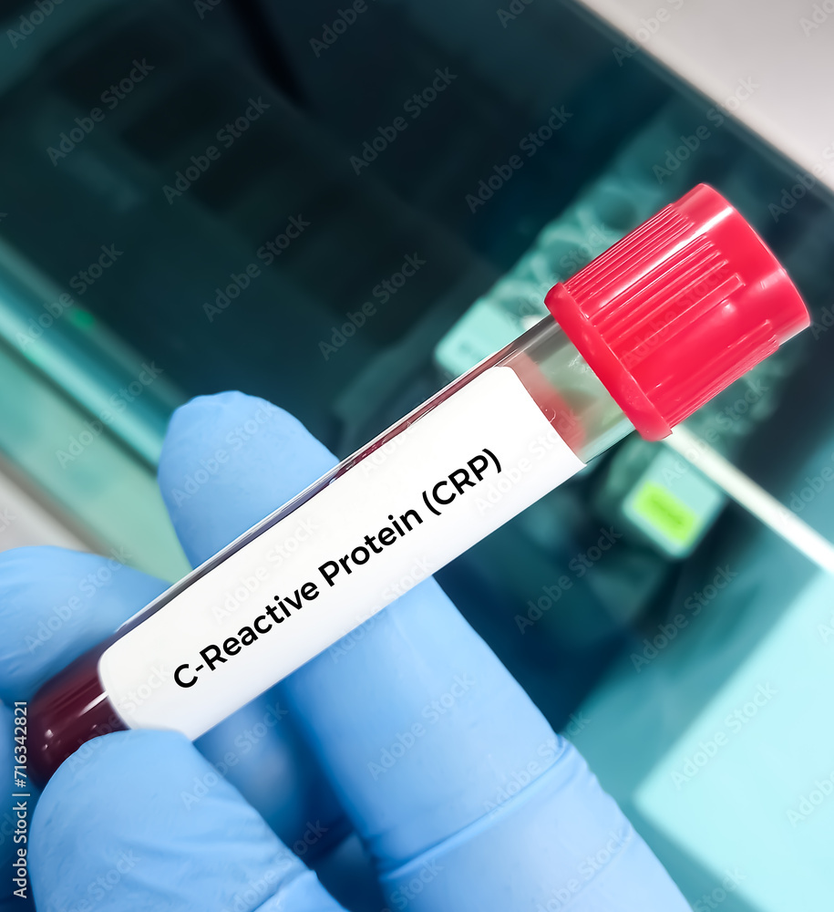 Blood sample for CRP(C-reactive protein) test used to identify ...
