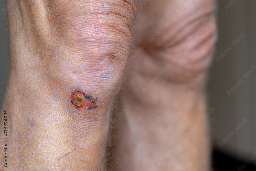 First aid and injuries concept, A man show his leg with little bit ...