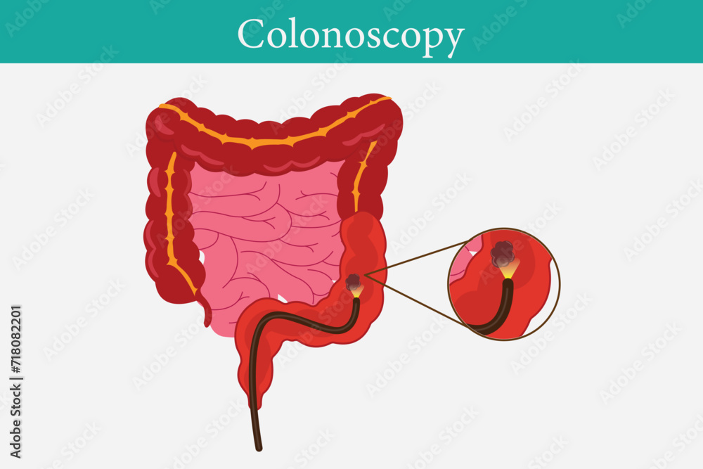 Colonoscopy treatment, familial adenomatous polyposis. Examination and ...