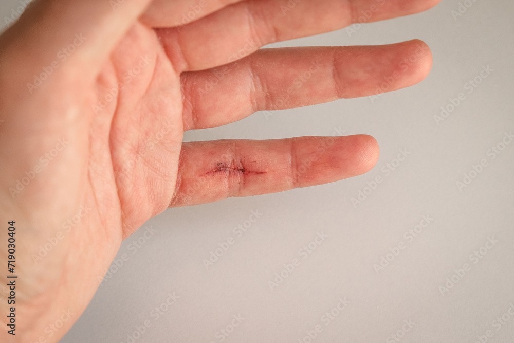 Scar on a woman's finger. The wound damage on epidermis, outermost ...