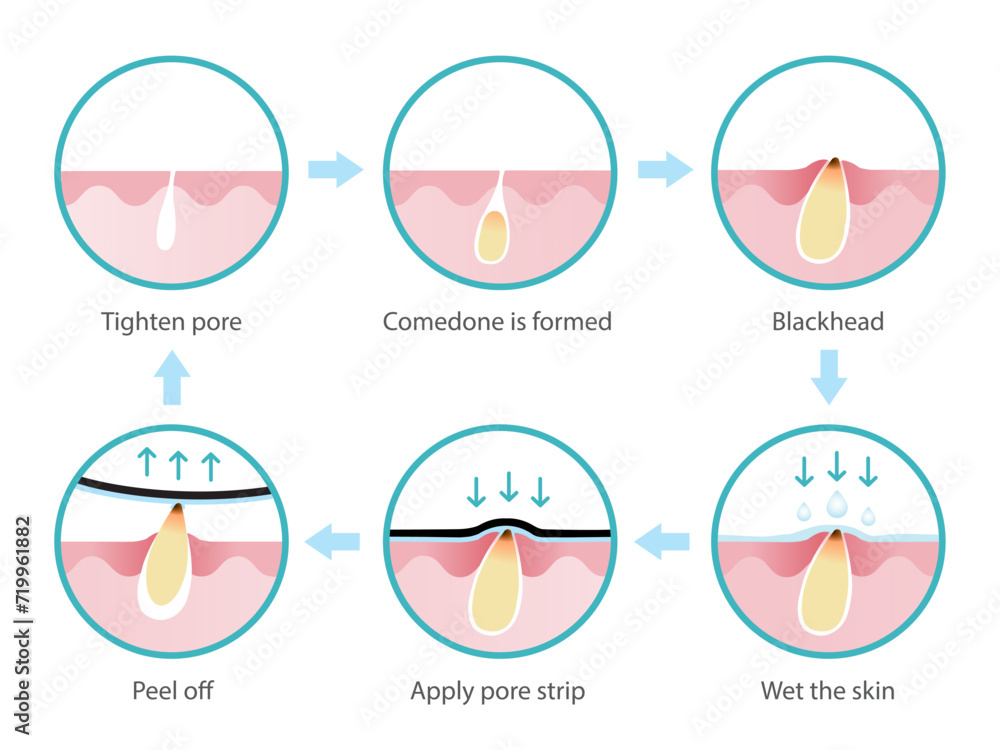 Life cycle of blackhead removal vector isolated on white background ...