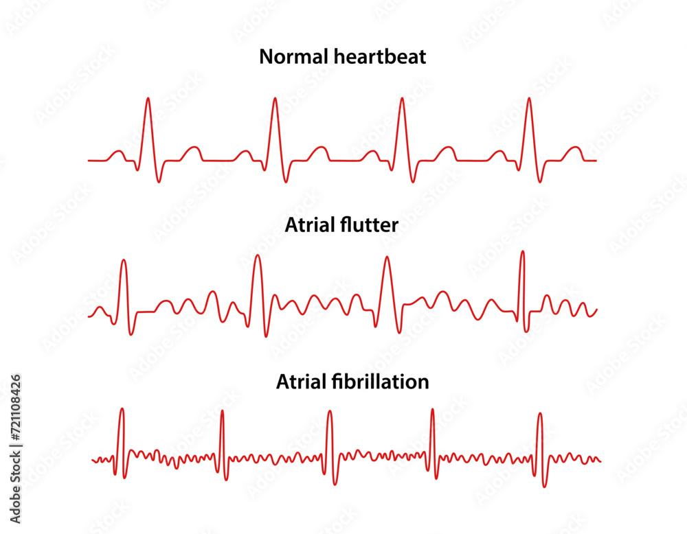 Diagram of normal rhythm, Atrial flutter and Atrial fibrillation for a human heart. Heart ...