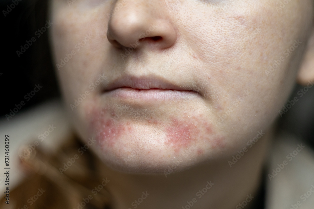 Perioral dermatitis on woman face. Closeup dermatitis on skin, ill ...