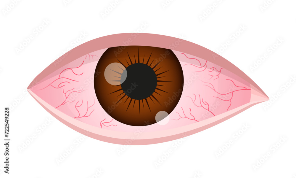 Dry eye syndrome. Inflamed bloodshot eyeball with swelling, irritation ...