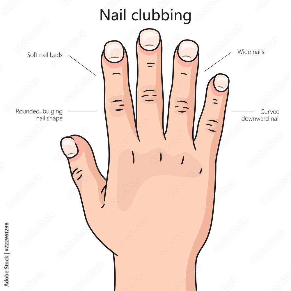 Nail clubbing diagram hand drawn schematic raster illustration. Medical ...