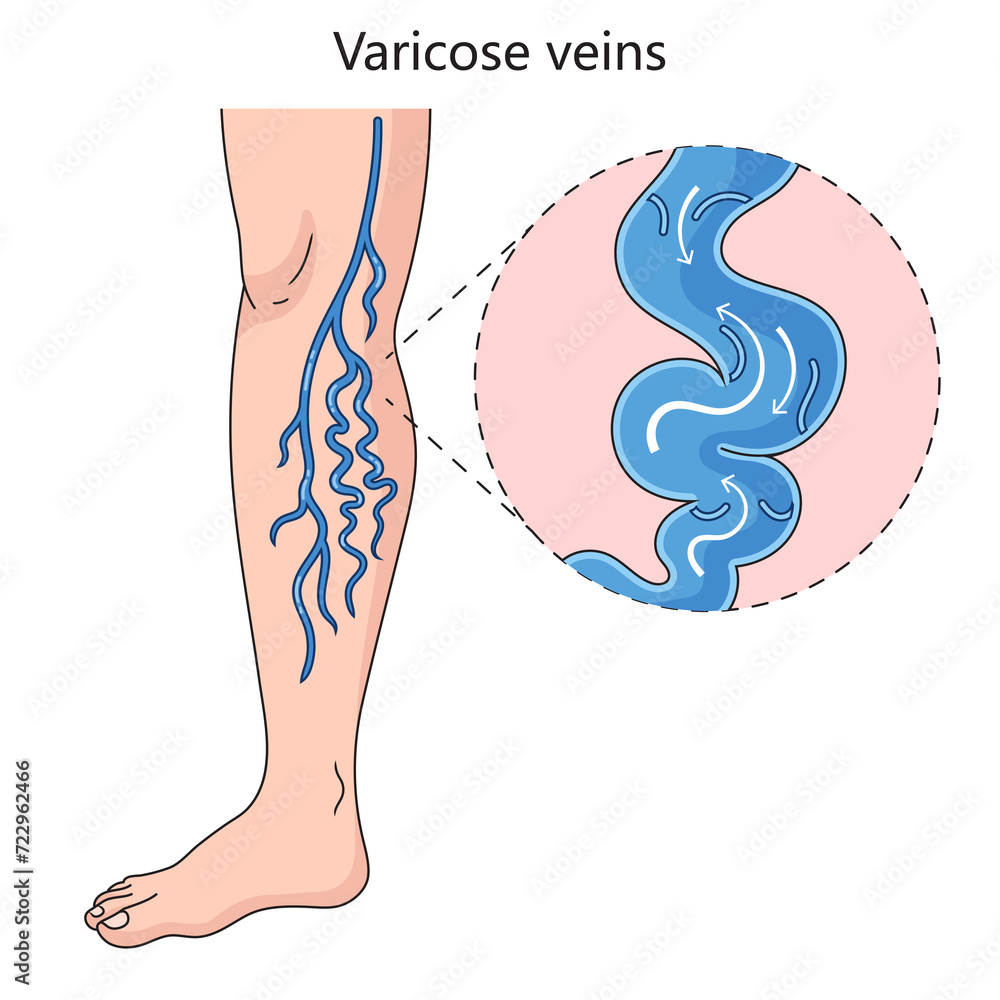 Varicose veins structure diagram hand drawn schematic raster ...