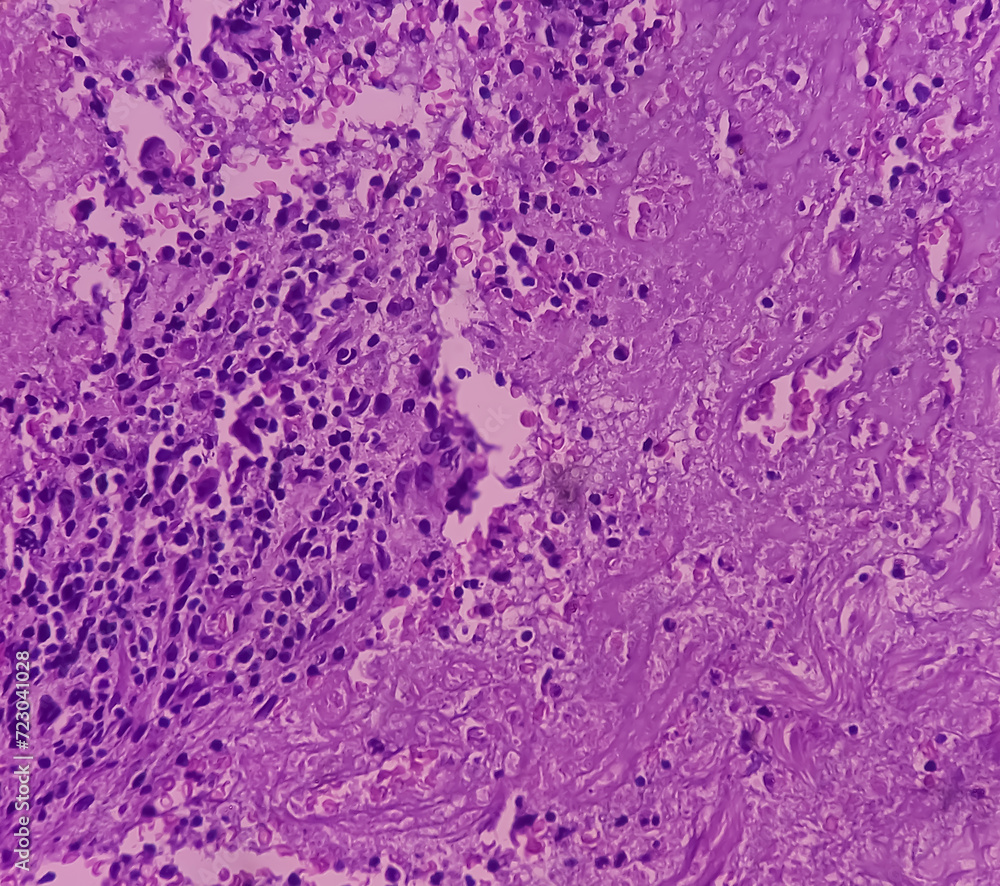 Cold abscess wall (biopsy). Chronic granulomatous inflammation (CGI ...