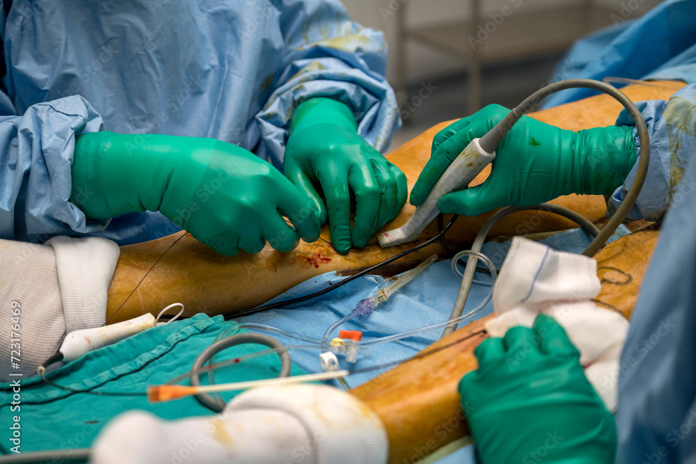 Photo Stock Process of varicose vein surgery in hospital, vein sealing ...