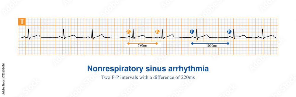 In some cases, sinus arrhythmia is not related to respiratory movements ...