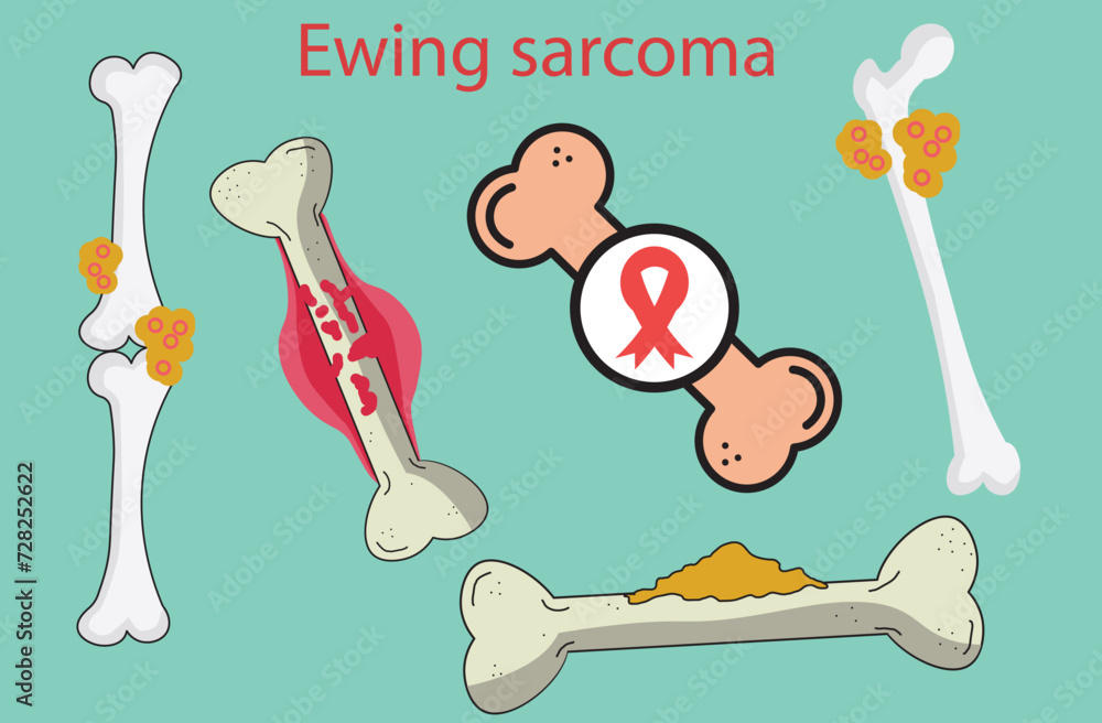 Ewing sarcoma,bone cancer,cancer that develops in the body’s supporting ...
