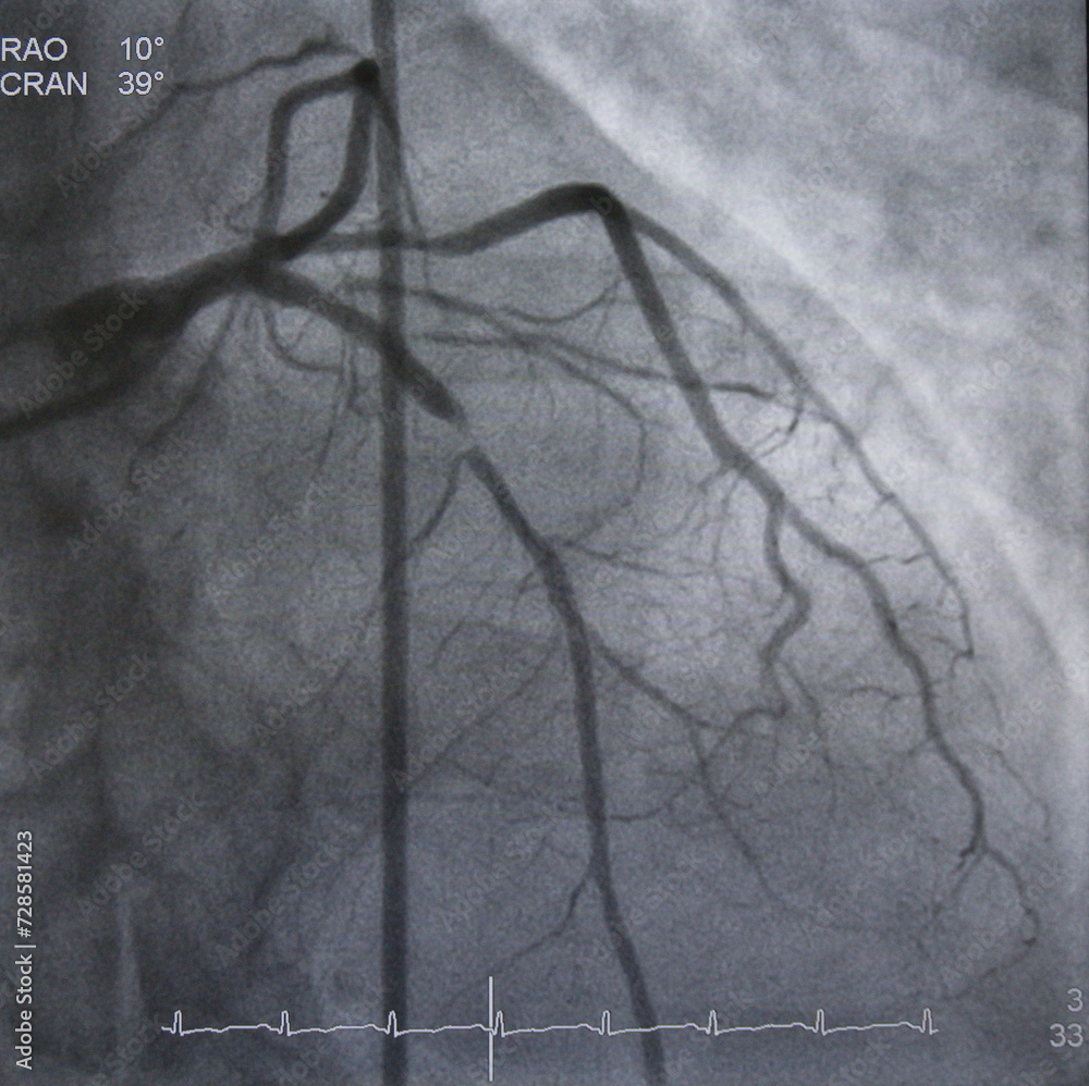Coronary angiogram (CAG) was performed left anterior descending artery ...