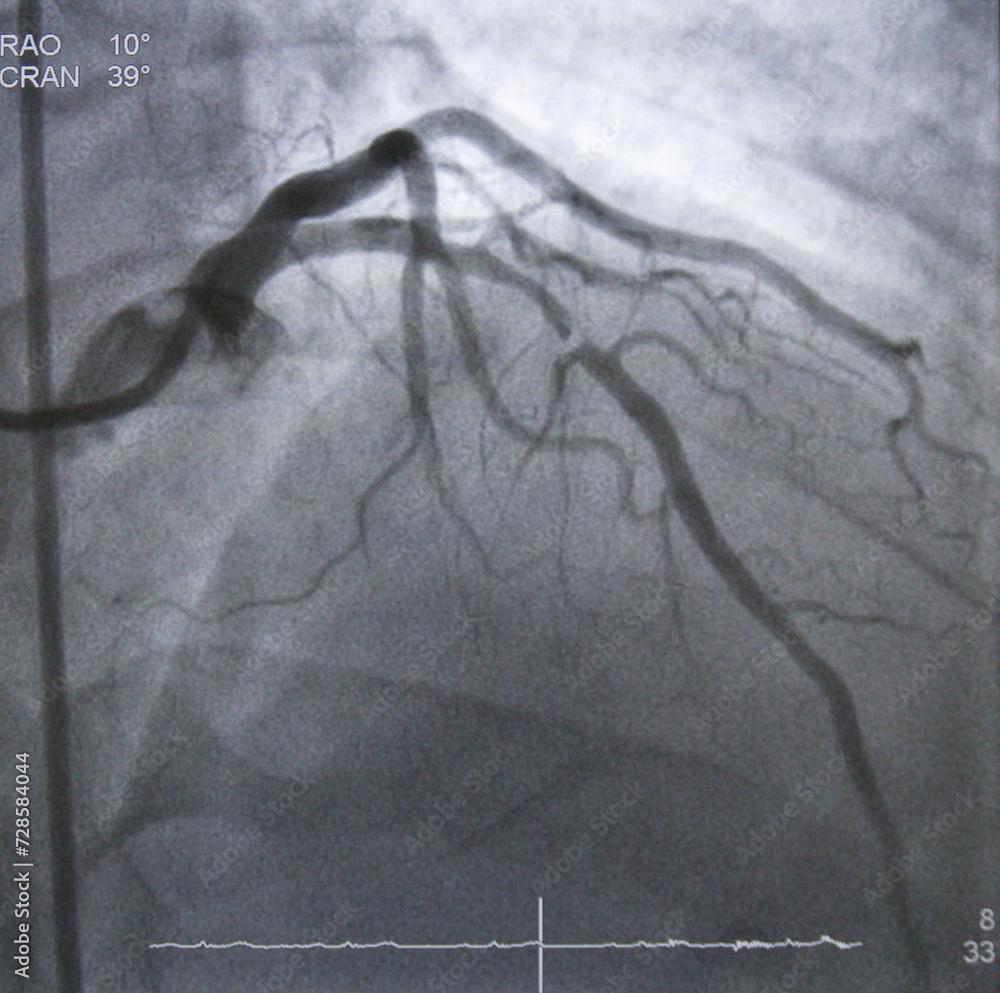 Coronary angiogram (CAG) was performed left anterior descending artery ...