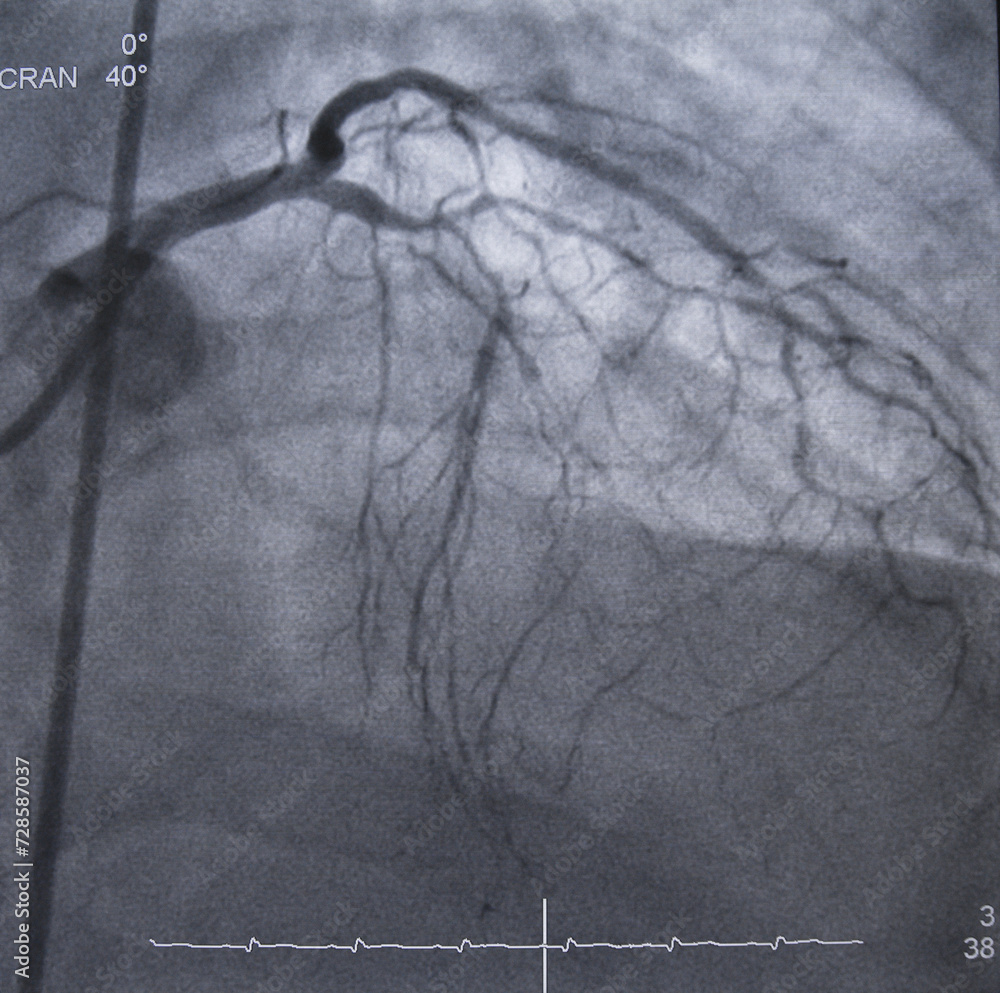 Coronary angiogram (CAG) was performed chronic total occlusion (CTO) at ...
