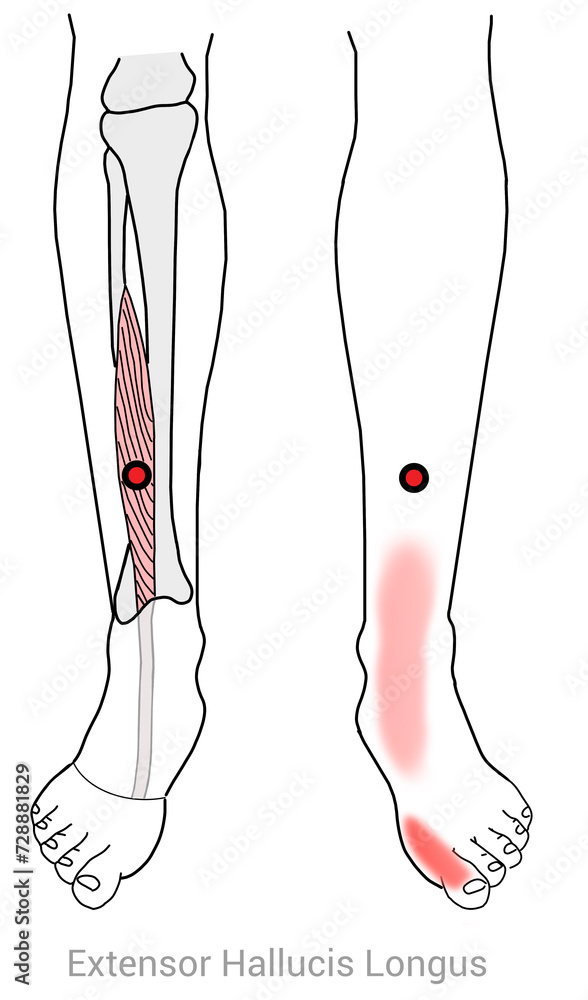 Extensor Hallucis Longus: Myofascial trigger points and associated pain ...