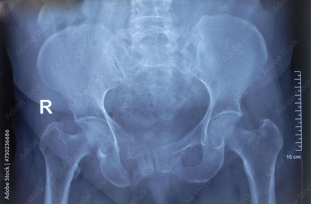 X-ray image of female pelvic. Scleroses are noted at the articular ...