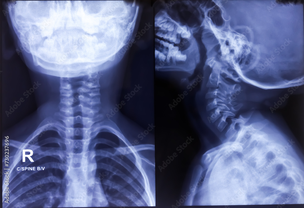 Cervical spine x-ray showing normal radiography. Stock Photo | Adobe Stock