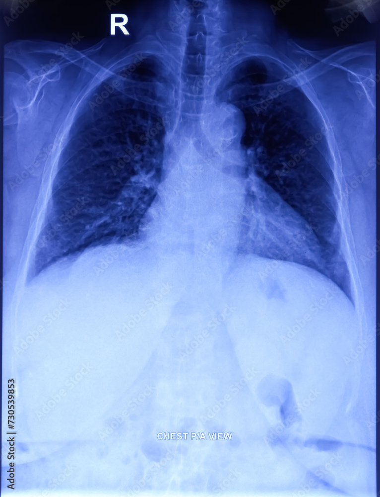 CXR (X-ray of chest) PA view. Pulmonary tuberculosis and ...