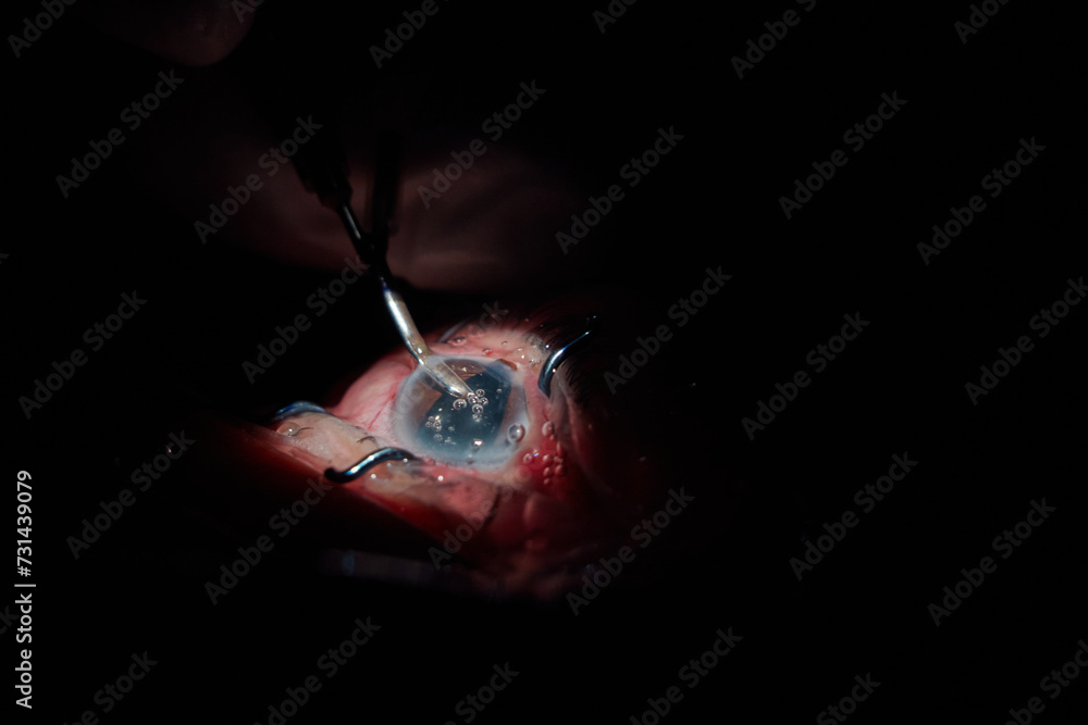 Phacoemulsification, destruction of the opaque lens by ultrasound ...