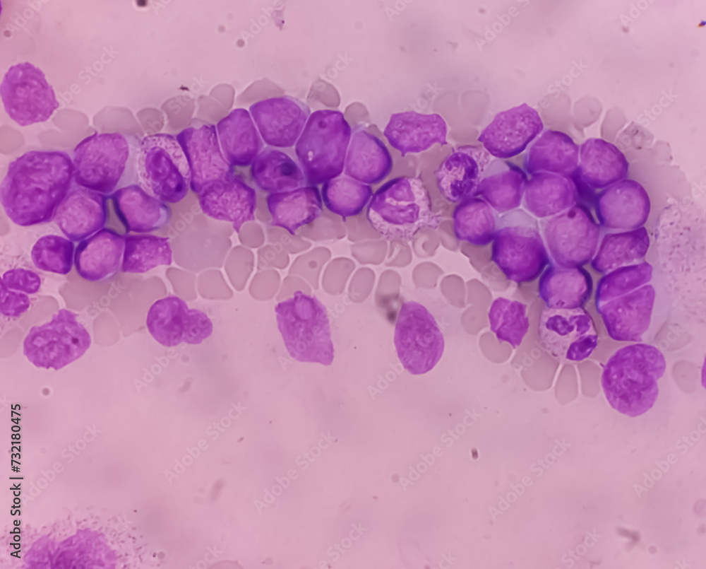Acute myeloid leukemia (AML). Smear show shift maturation of then are ...