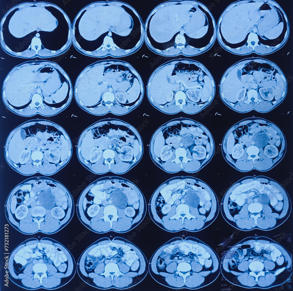 CT (computerized tomography) urogram. Spindle cell tumor of left testis ...