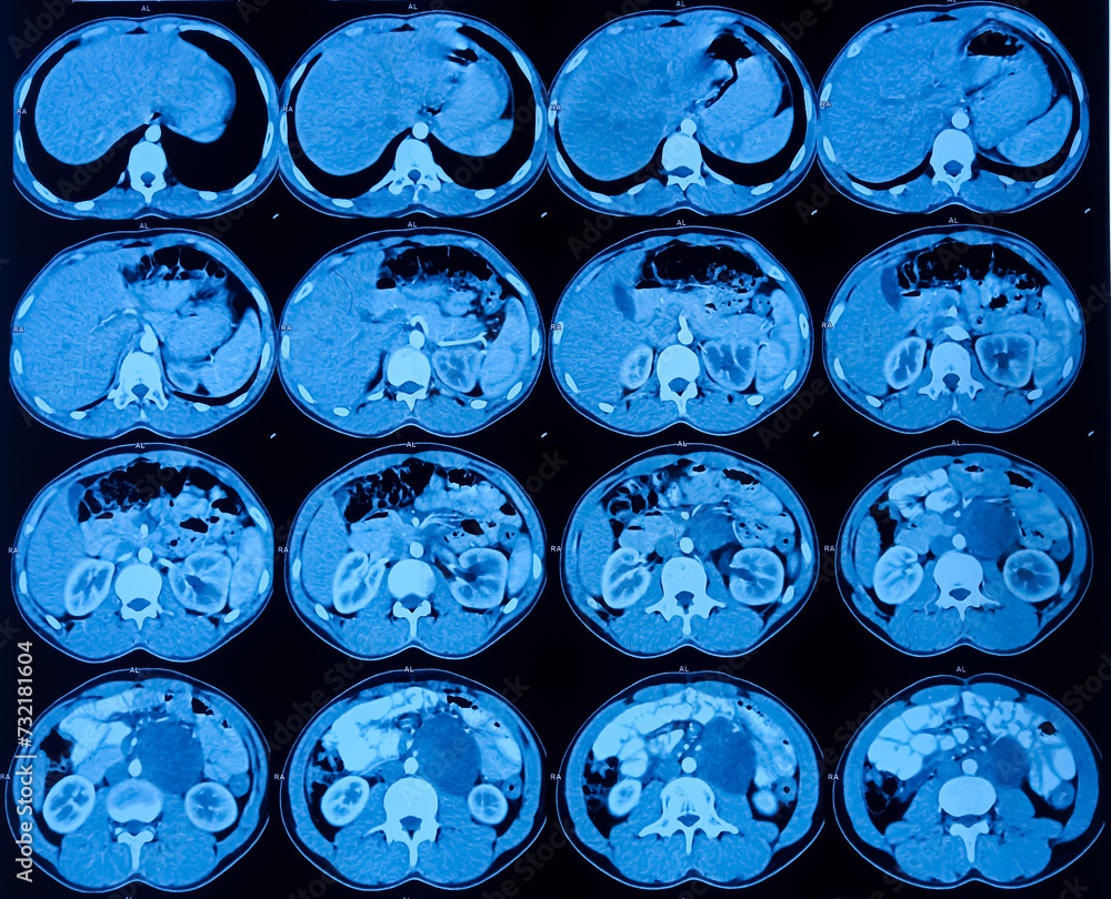CT (computerized tomography) urogram. Spindle cell tumor of left testis ...