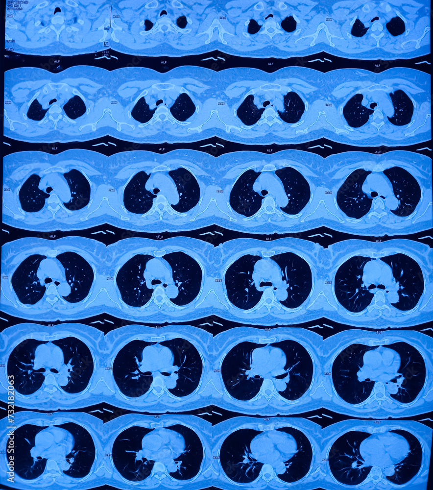 Foto de Stock Multi slice HRCT scan of chest. Prominent Broncho ...