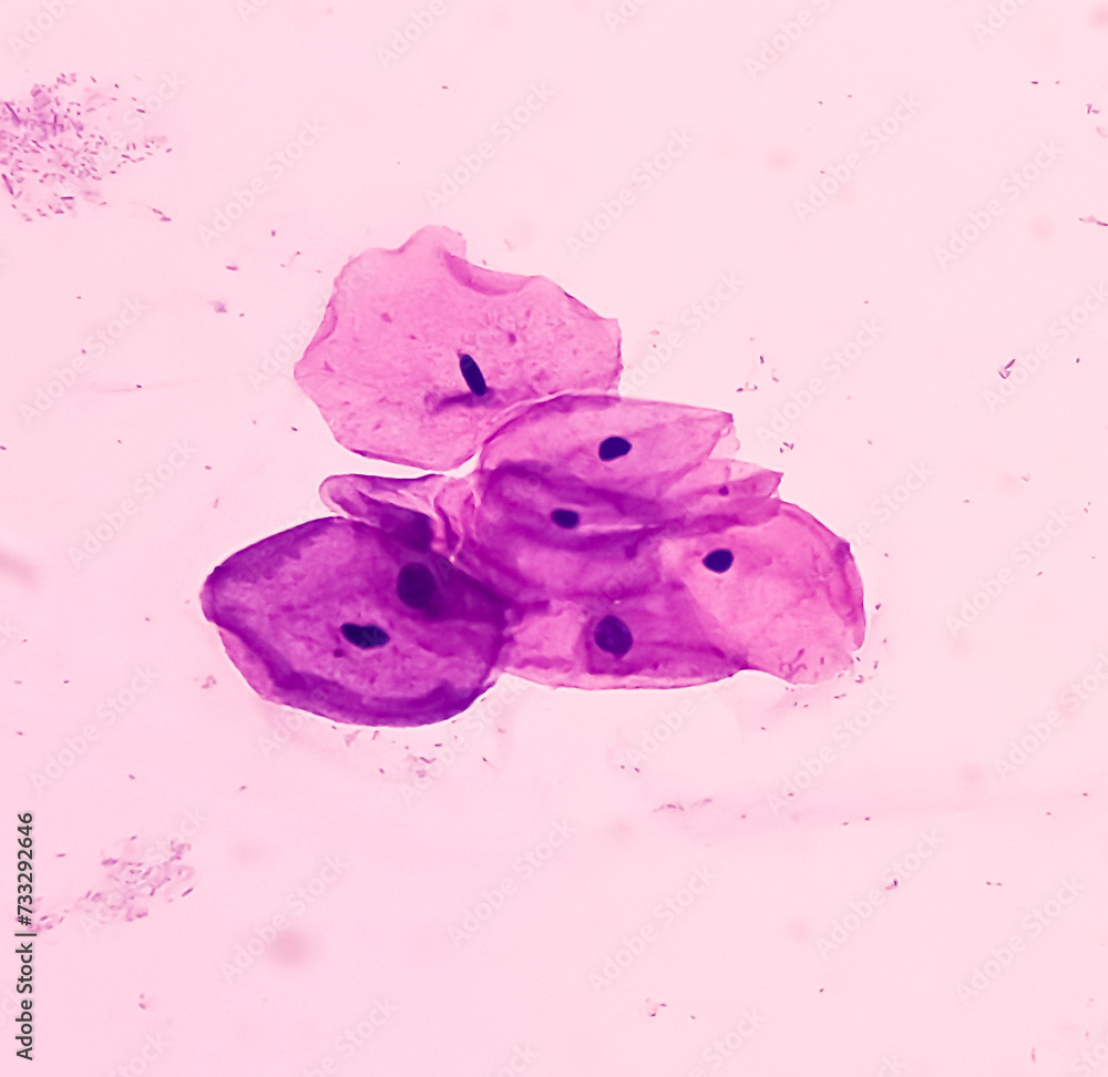 Pap's smear. Microscopic examination of pap smear showing inflammatory ...