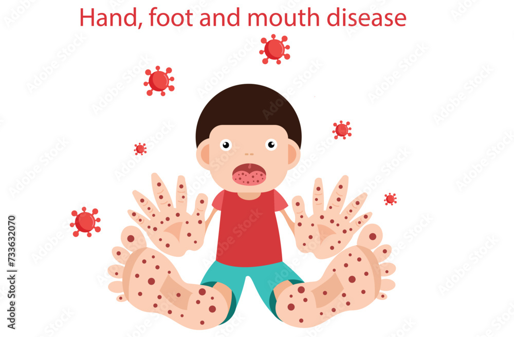 Hand, foot and mouth disease,mouth ulcers and spots on the hands and ...