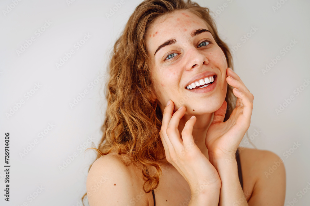 Young woman with problem skin. Life with acne. Problem skin prone to ...