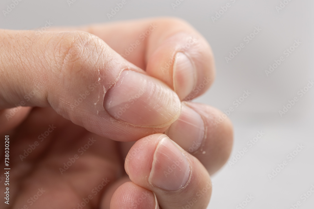 Ridged fingernails with vertical and horizontal ridges. Nails problems ...