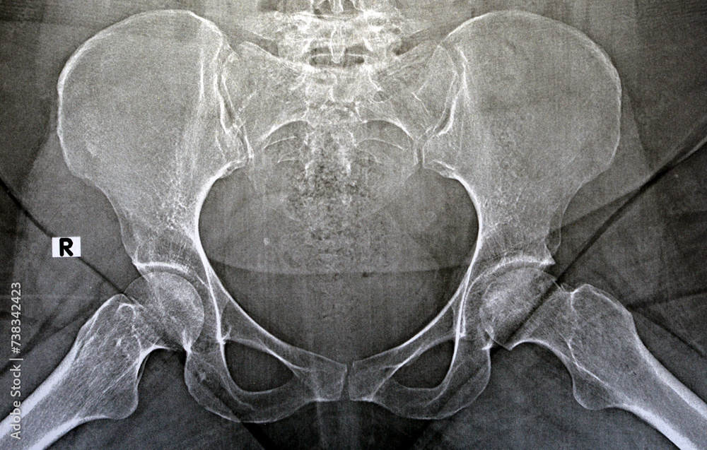 Plain X ray reveals bilateral Avascular necrosis (AVN) of the femoral ...