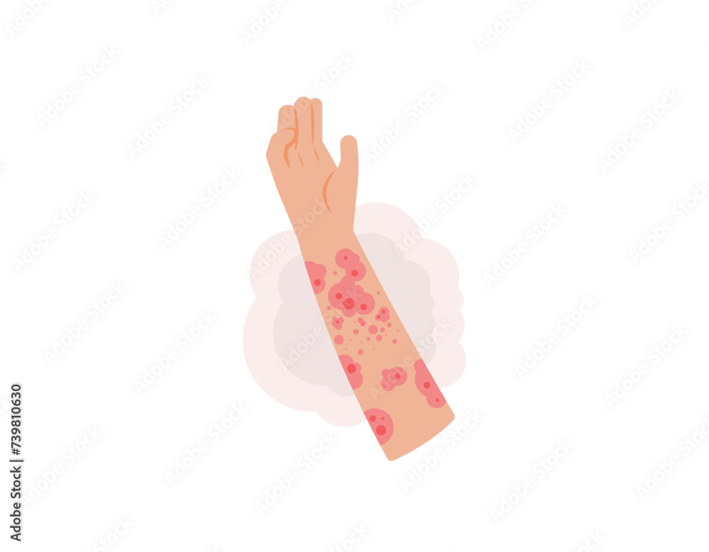 Vektor lichen planus disease. illustration of a hand with red spots on ...